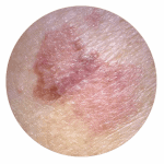 Skin Cancer Signs & Symptoms | The Dermatologist's Essential Guide