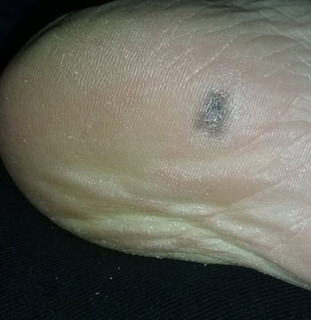 Skin Cancer Pictures | Most Common Skin Cancer Types with Images