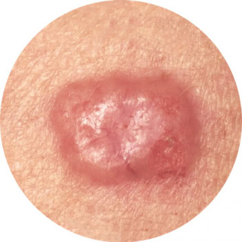 Skin Cancer - Types, Symptoms, Causes and Prevention