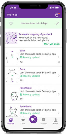 Mole Checking App | Check Your Moles for Changes over Time