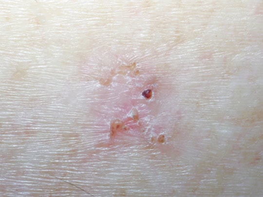 Basal Cell Carcinoma - Symptoms, Types and Pictures