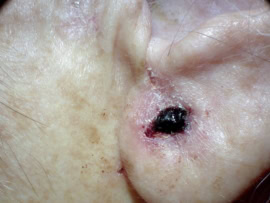 Basal Cell Carcinoma - Symptoms, Types and Pictures