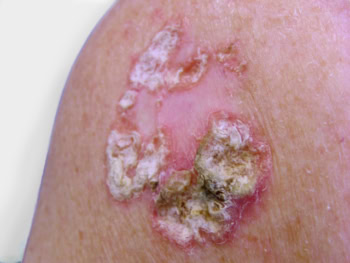 Basal Cell Carcinoma - Symptoms, Types and Pictures