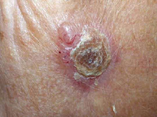 Basal Cell Carcinoma - Symptoms, Types and Pictures