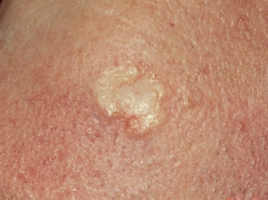 Basal Cell Carcinoma - Symptoms, Types and Pictures