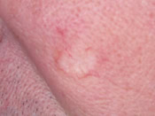 Basal Cell Carcinoma - Symptoms, Types and Pictures