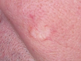 Basal Cell Carcinoma - Symptoms, Types and Pictures