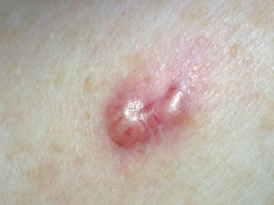 Basal Cell Carcinoma - Symptoms, Types and Pictures