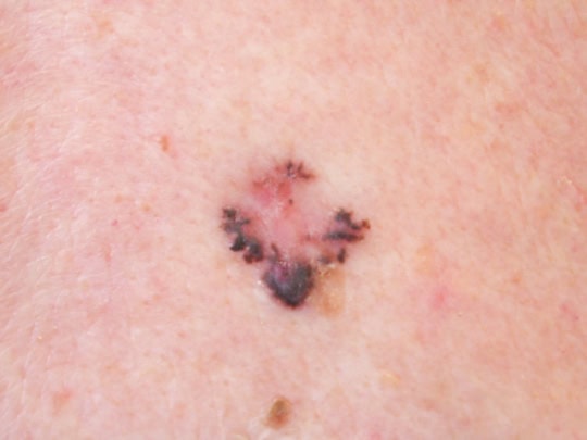 Basal Cell Carcinoma - Symptoms, Types and Pictures