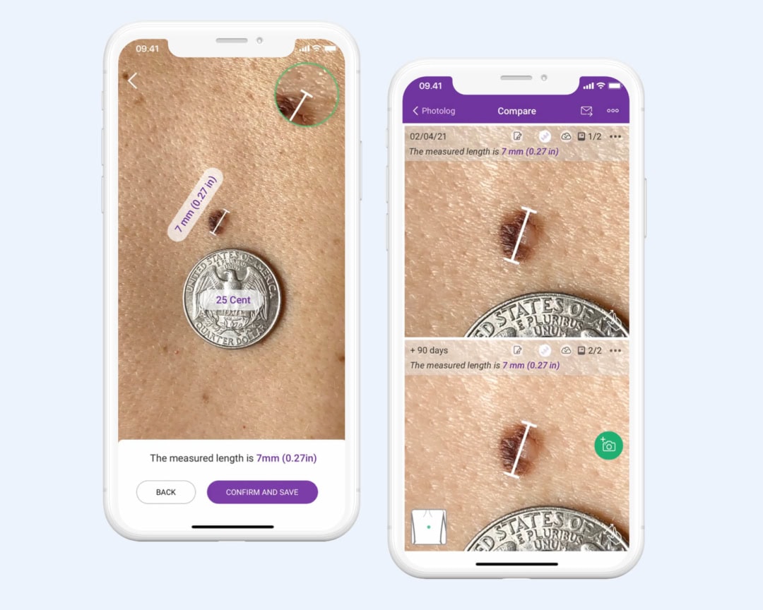 Mole Sizing - Measure Your Moles With Miiskin