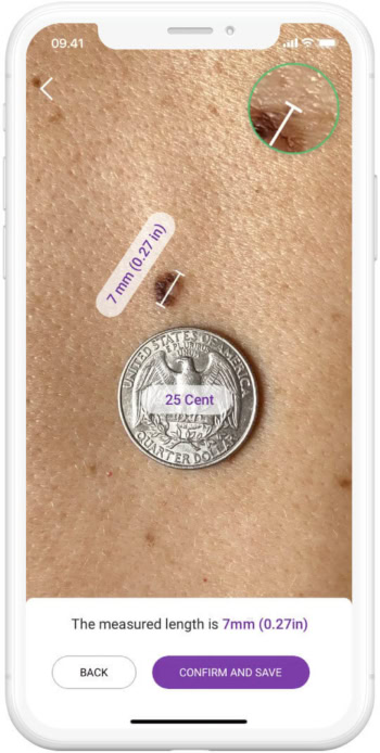 Skin and Mole Checker App | Track Your Skin and Moles