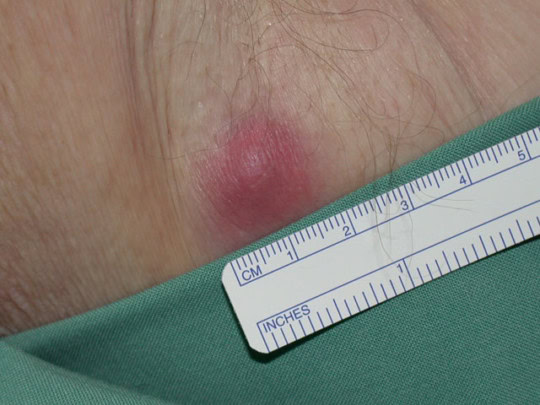 Skin Lesions: Types, Pictures & Prevention