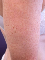 Skin Lesions: Types, Pictures & Prevention