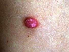 Skin Lesions: Types, Pictures & Prevention