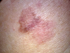 Skin Lesions: Types, Pictures & Prevention