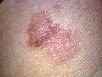 Skin Lesions: Types, Pictures & Prevention