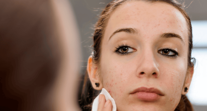 Adapalene vs Tretinoin: Treatment of Acne on Sensitive Skin