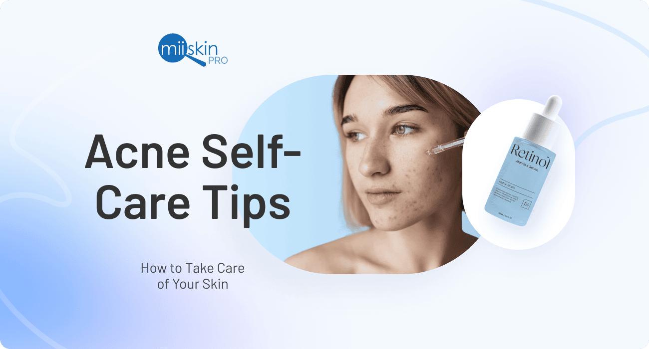 Acne: Causes, Treatment and Care Tips for Acne-prone Skin