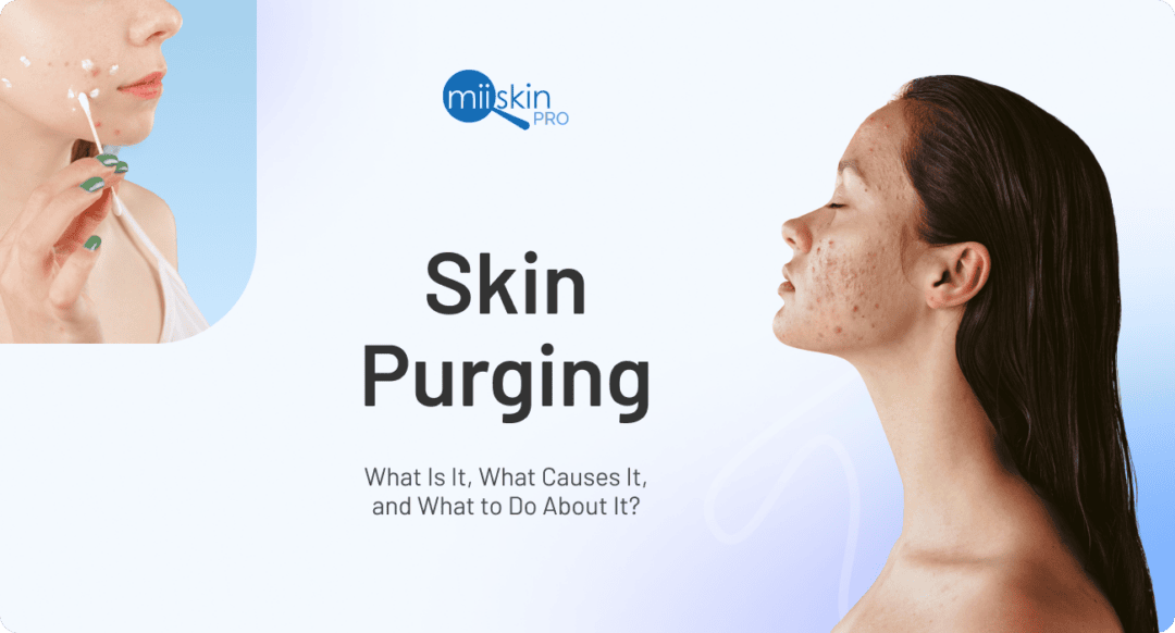 Acne: Causes, Treatment and Care Tips for Acne-prone Skin