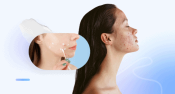 Skin Purging - What Is It and What Medicines Can Cause It?