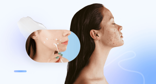 What to expect when using clindamycin gel for acne?