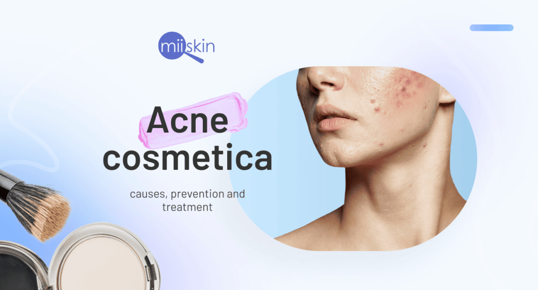 Acne: Causes, Treatment and Care Tips for Acne-prone Skin