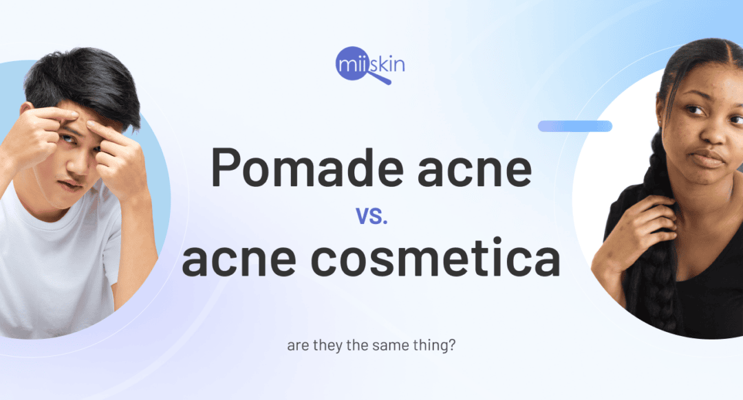 Acne: Causes, Treatment and Care Tips for Acne-prone Skin