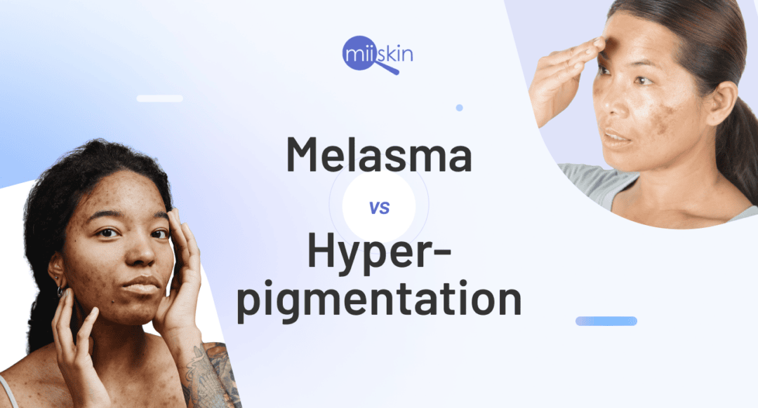 Get a Hyperpigmentation Cream Prescription Online