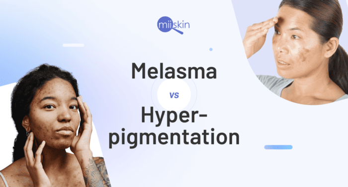 Hyperpigmentation Cream Prescription by Dermatologist