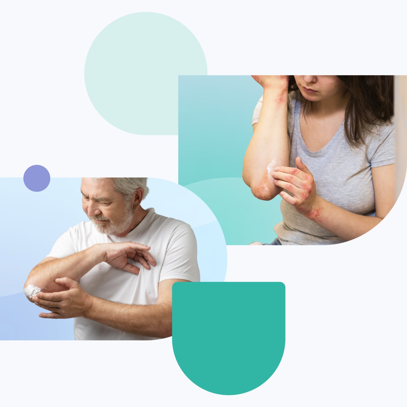 16 over-the-counter psoriasis medications