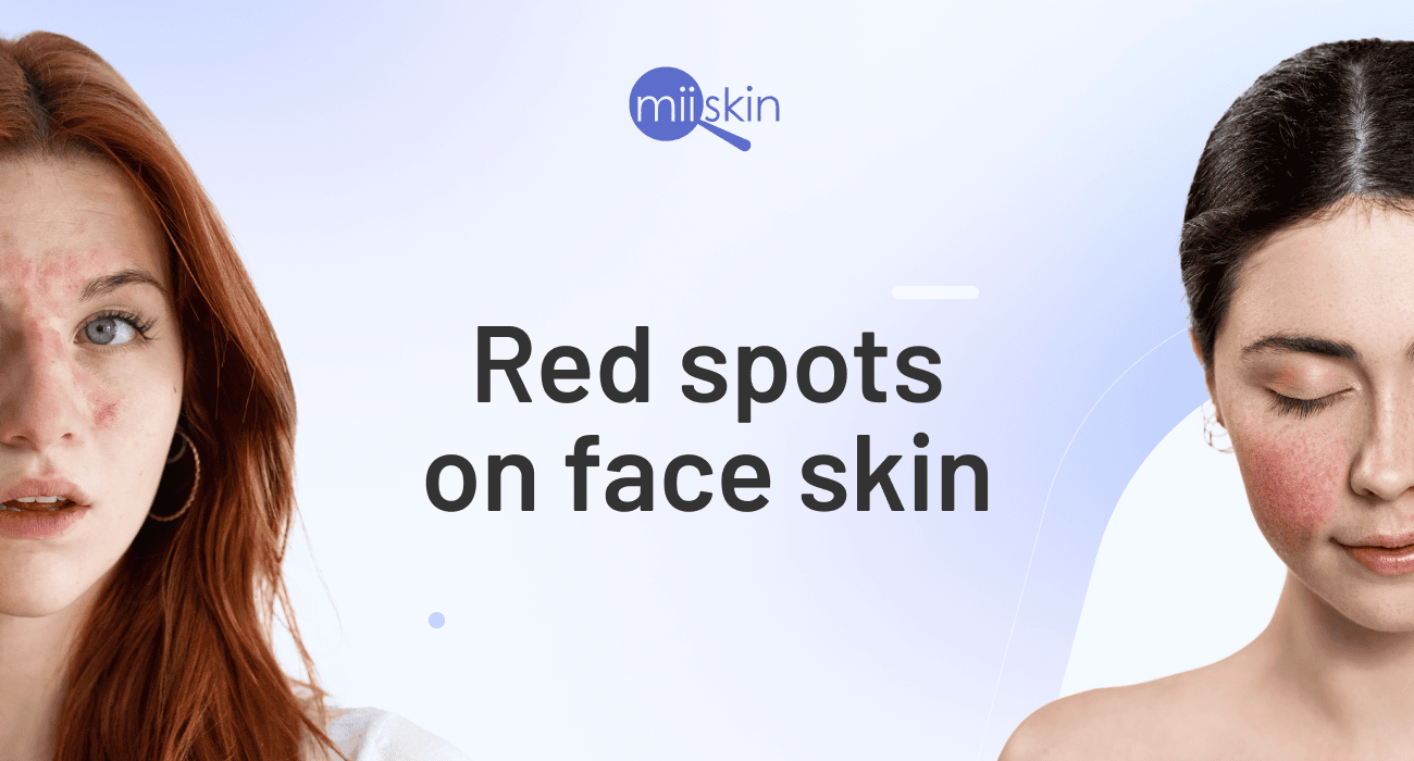 Small Red Spots On Face Not Acne Infoupdate Small Red Spots On Face Not Acne Infoupdate