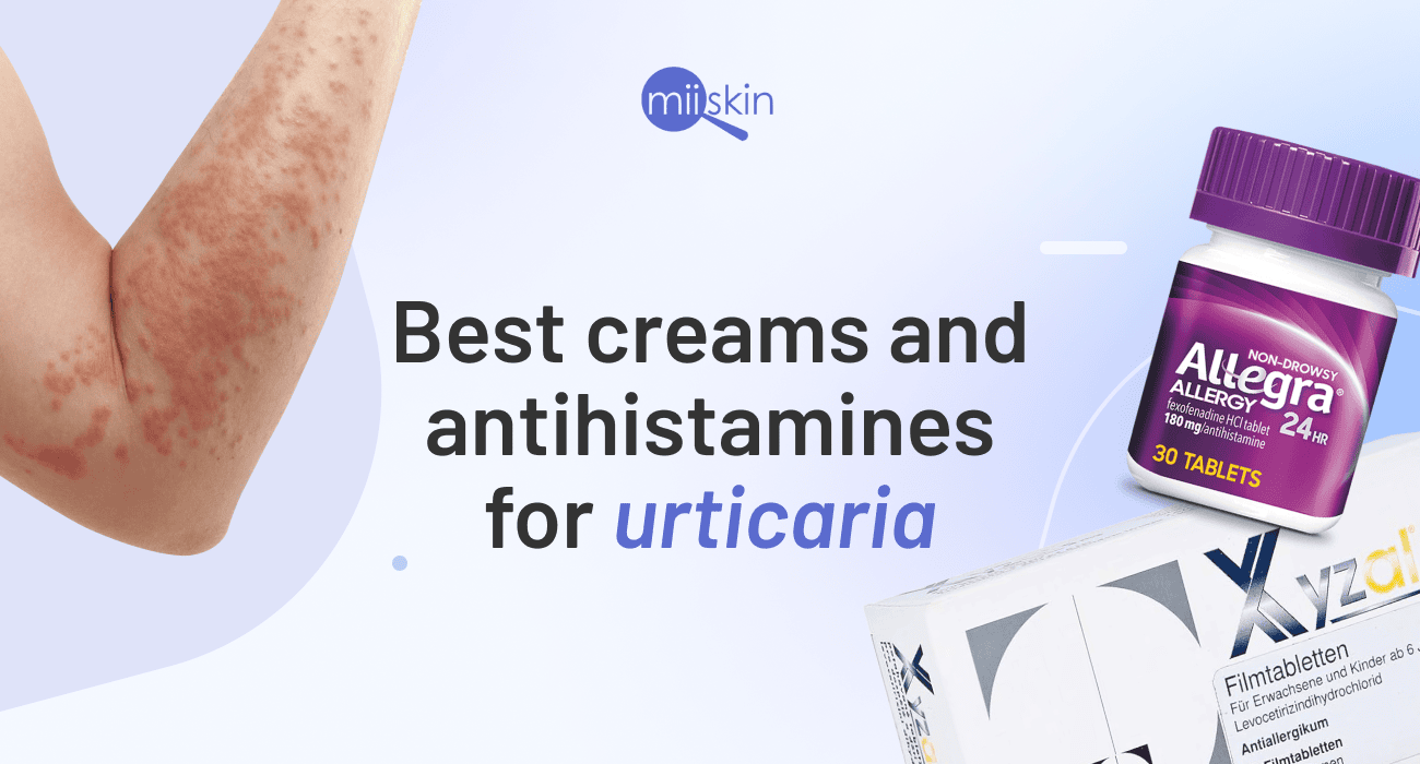 Best creams and antihistamines for urticaria