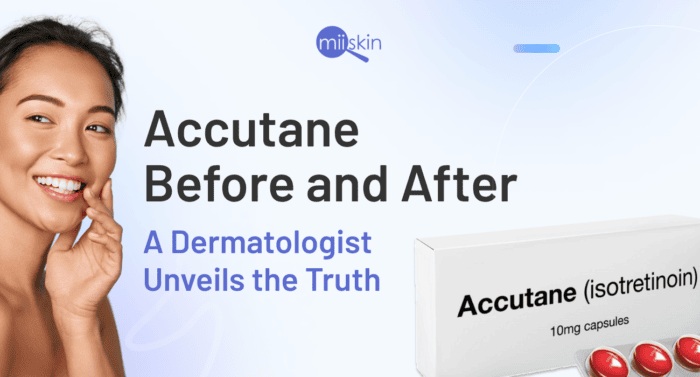 Accutane (isotretinoin): All you need to know