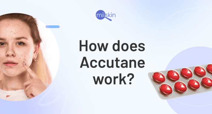 Accutane (isotretinoin): All you need to know