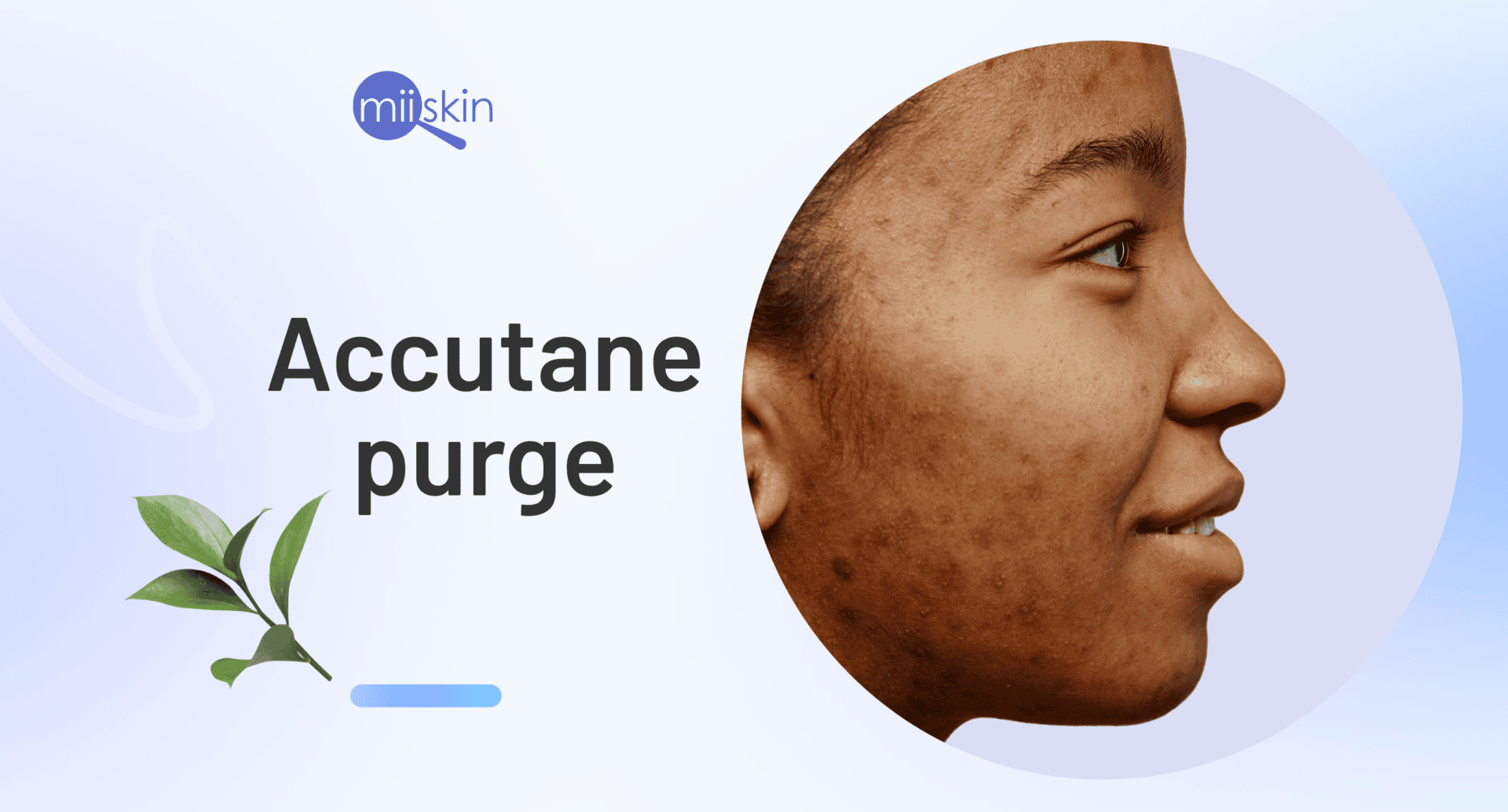 Accutane (isotretinoin): All you need to know