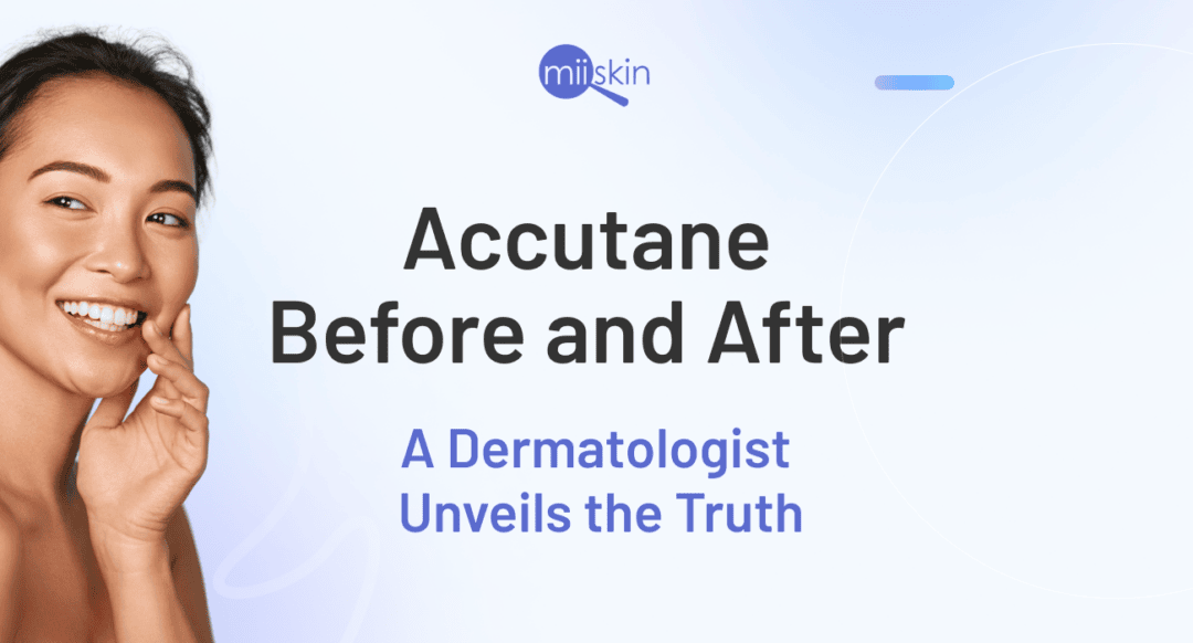 Accutane (isotretinoin): All you need to know