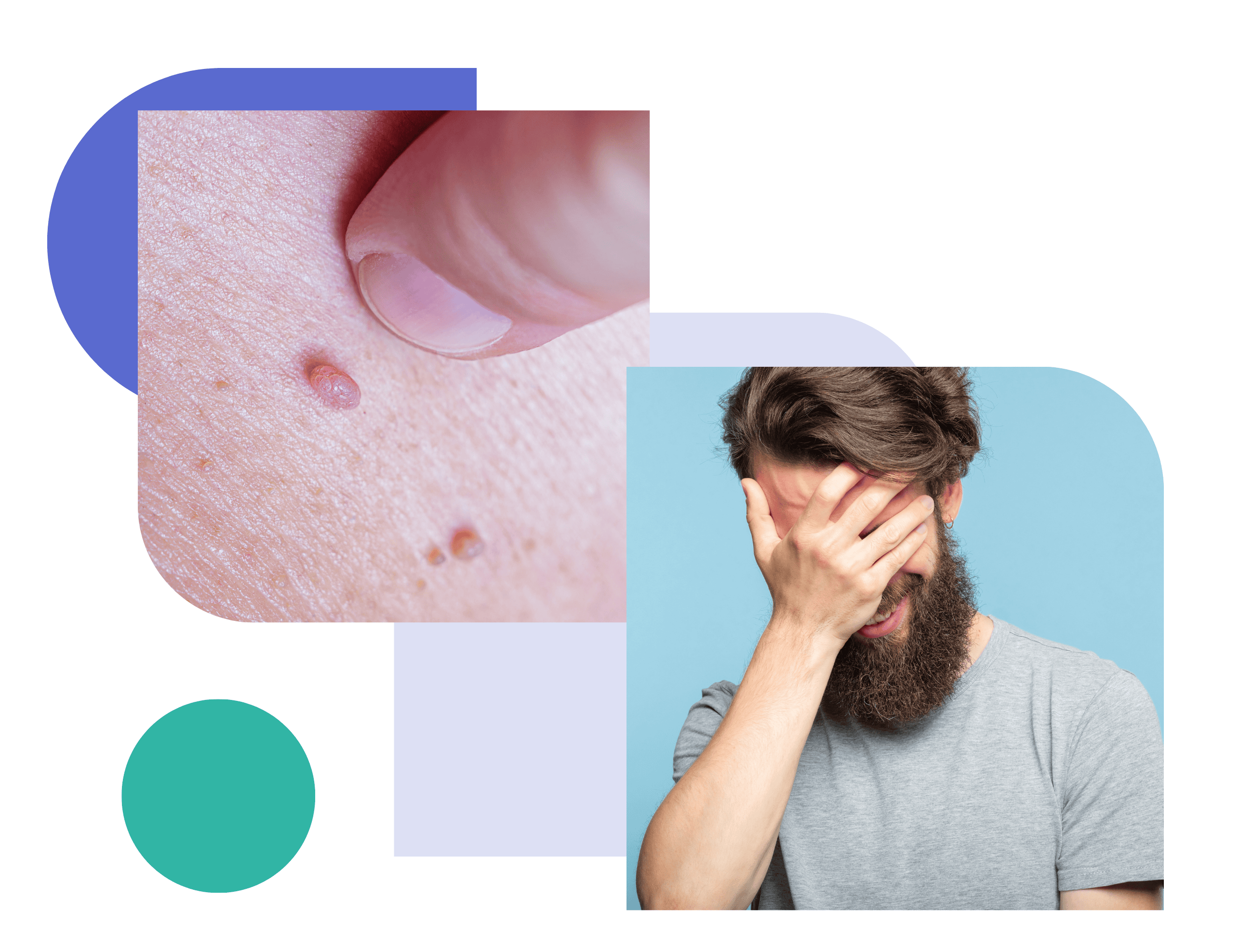 Get genital wart treatment online by dermatologist