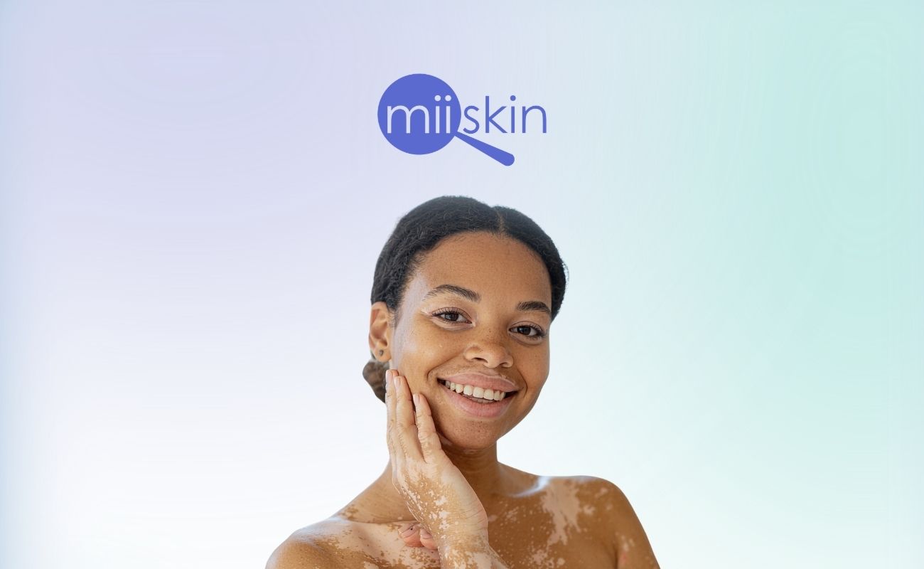How to get a vitiligo cream prescription by dermatologist