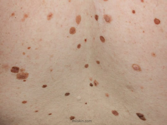 Atypical Moles Guide | Definitions, Pictures and Risks