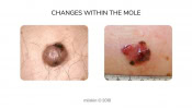 About Moles - Types, Warning Signs, Causes, and Prevention